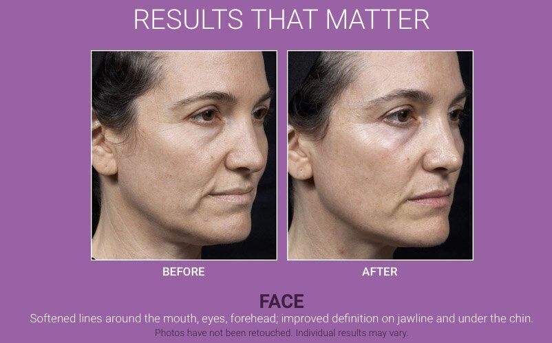 Thermage Eyes Before And After Thermage FLX – Onebeautyus