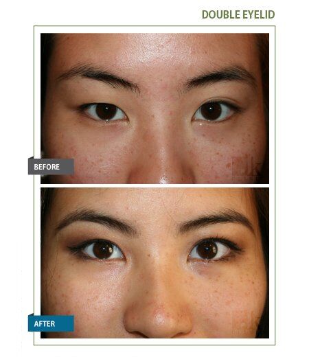 upper eyelid double fold